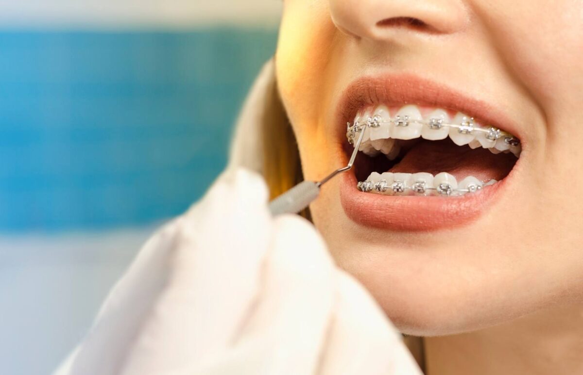How Do Braces Fix an Overbite | O'Gara-Gilbert-Silvaroli Orthodontics