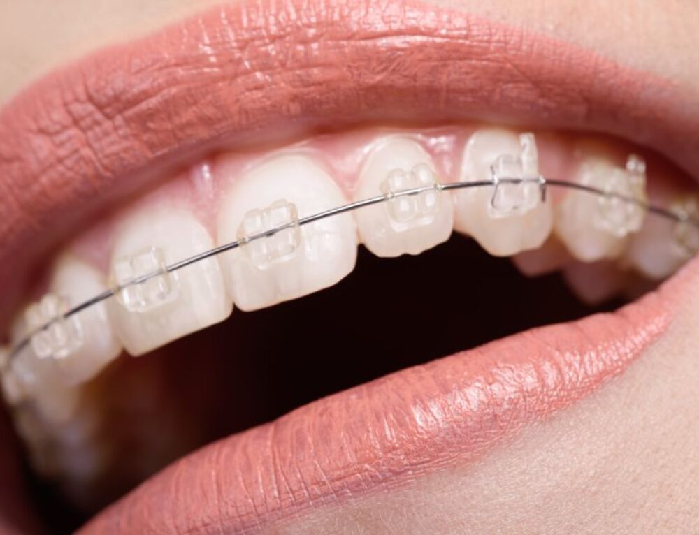 Common Teeth Alignment Problems | O'Gara-Gilbert-Silvaroli Orthodontics